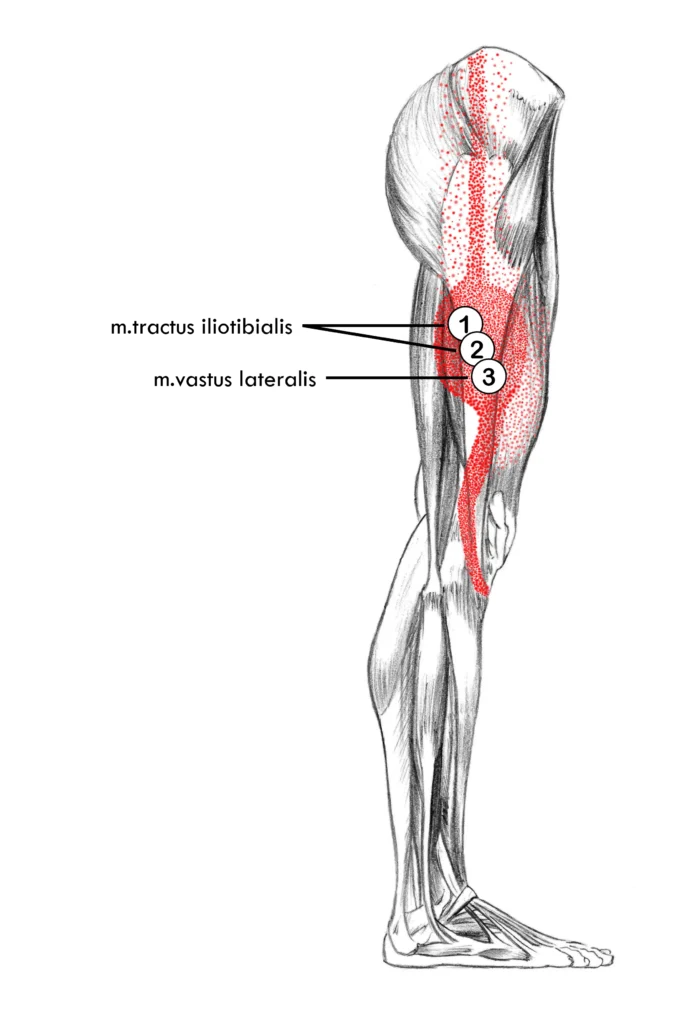 Side Legs Trigger Points - The|Tides BrainBodyMind Wellness